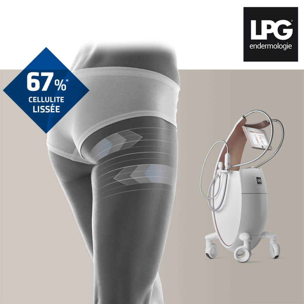 LPG Cellu M6 Lyon, soin Anti cellulite Cellu Alliance LPG à Lyon